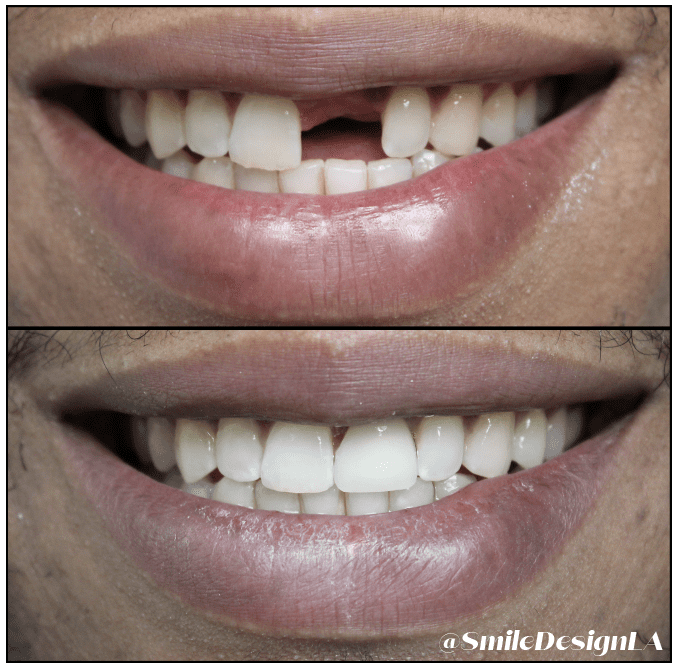 Gallery Smile Design Dental Los Angeles Ca